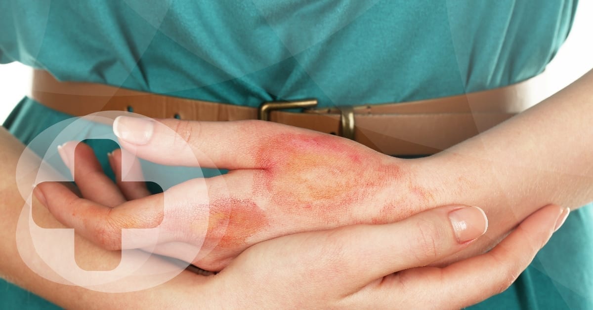 Femeale hand with burn damage | SkillBase First Aid